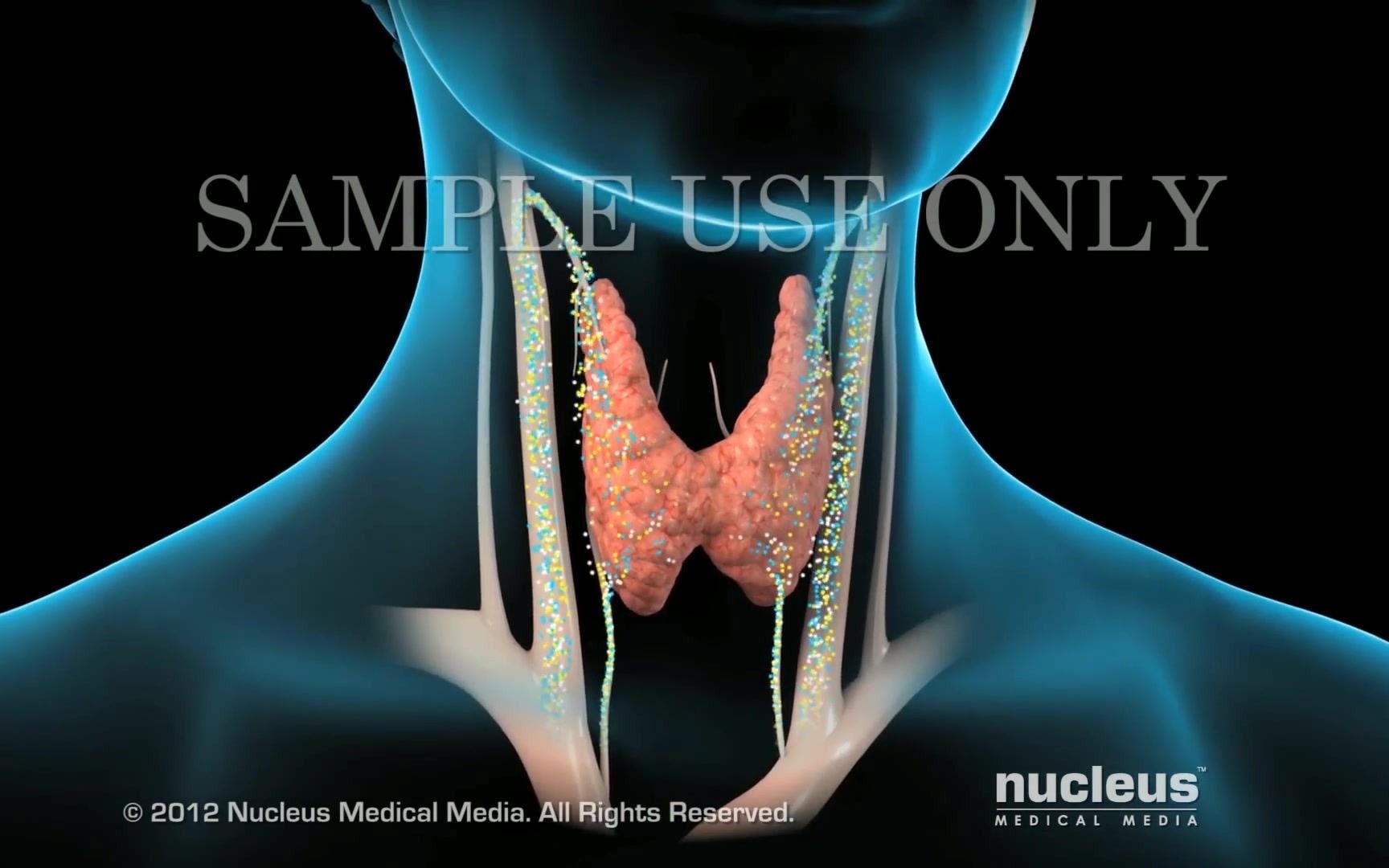【3D医学动画】一个女孩得了甲状腺癌,医生是如何切除她的甲状腺(...