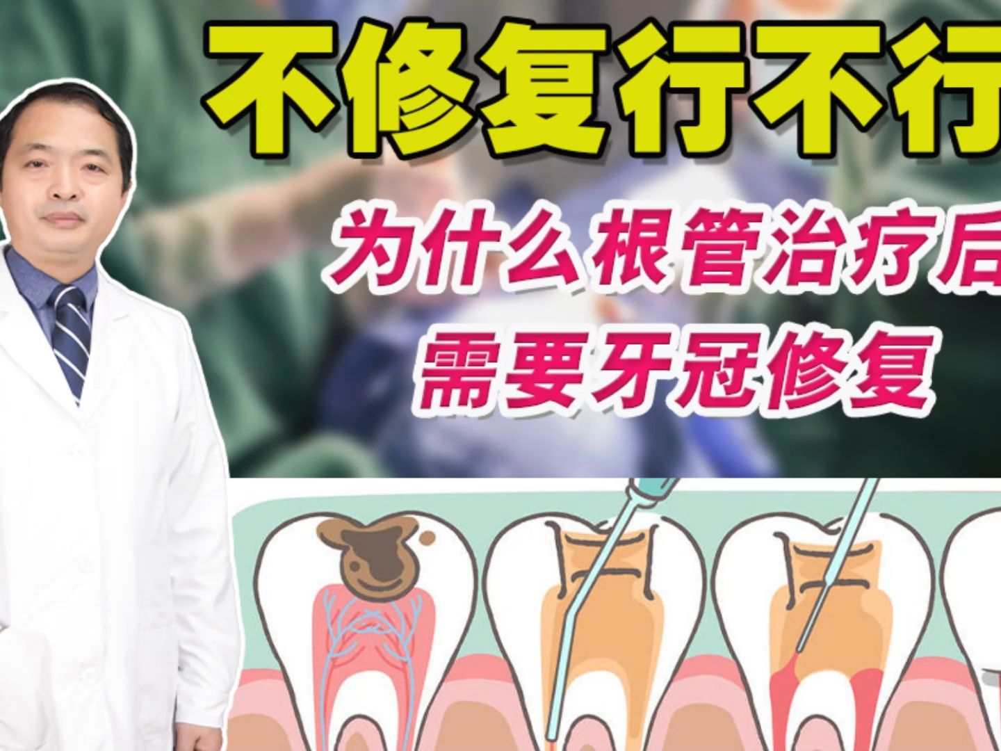 根管治疗能不能不做牙冠?