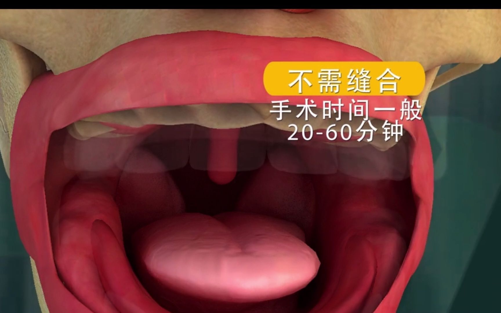 3D视频:扁桃体切除术