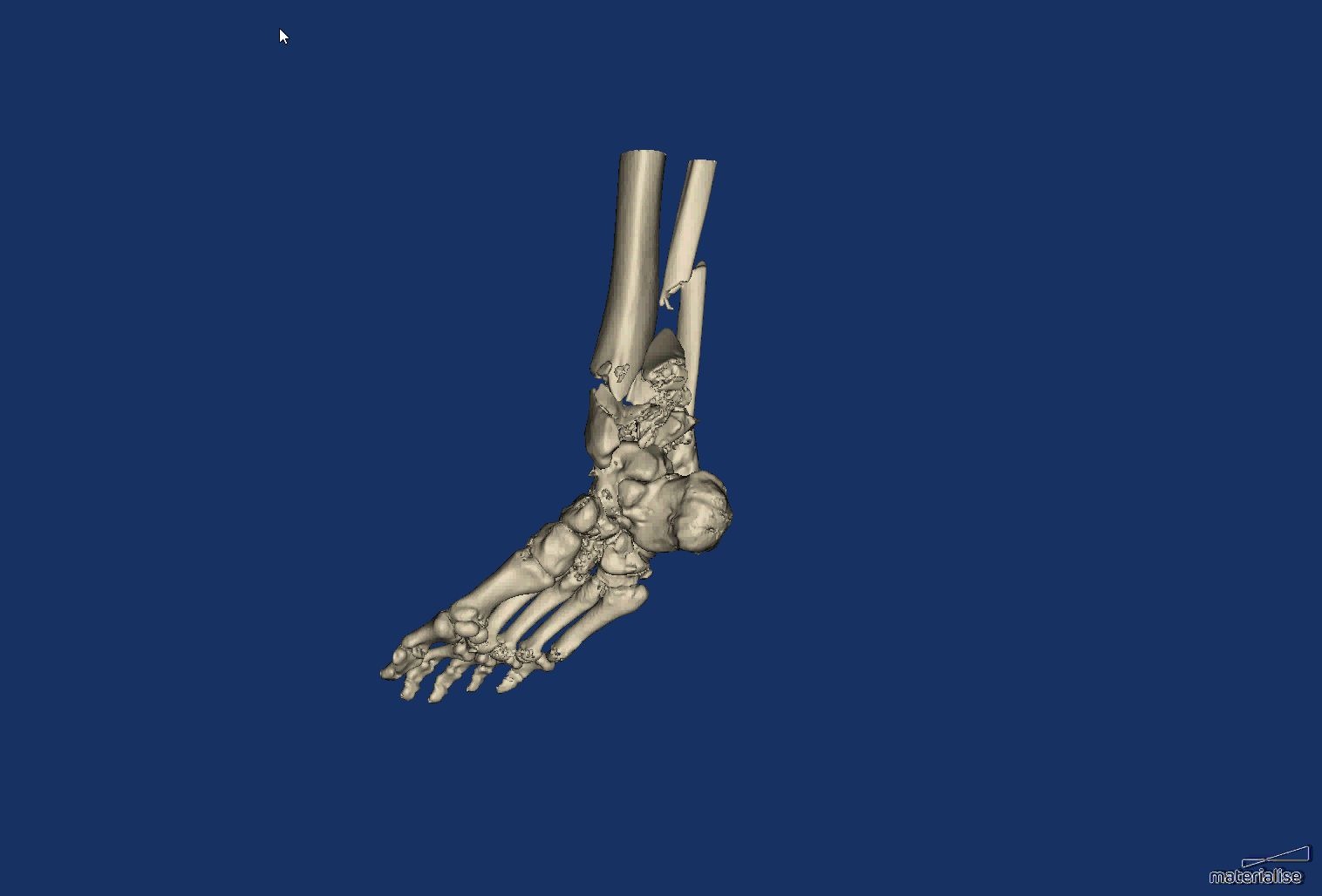 利用mimics进行建模-胫骨骨折