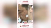 脸上意外受伤留下的疤痕要怎么祛除?