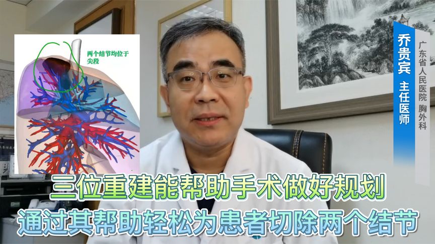 三维重建能精确定位肺结节位置,能为手术做好详细规划