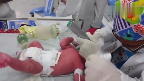 医生给新生婴儿插管,宝宝全程一声不吭,却让人心疼到想哭