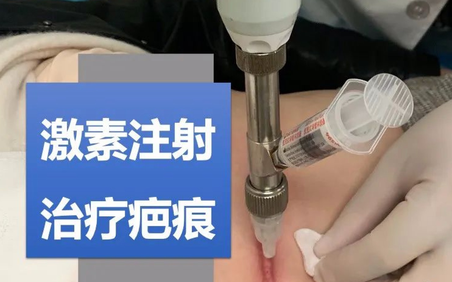 激素注射治疗疤痕