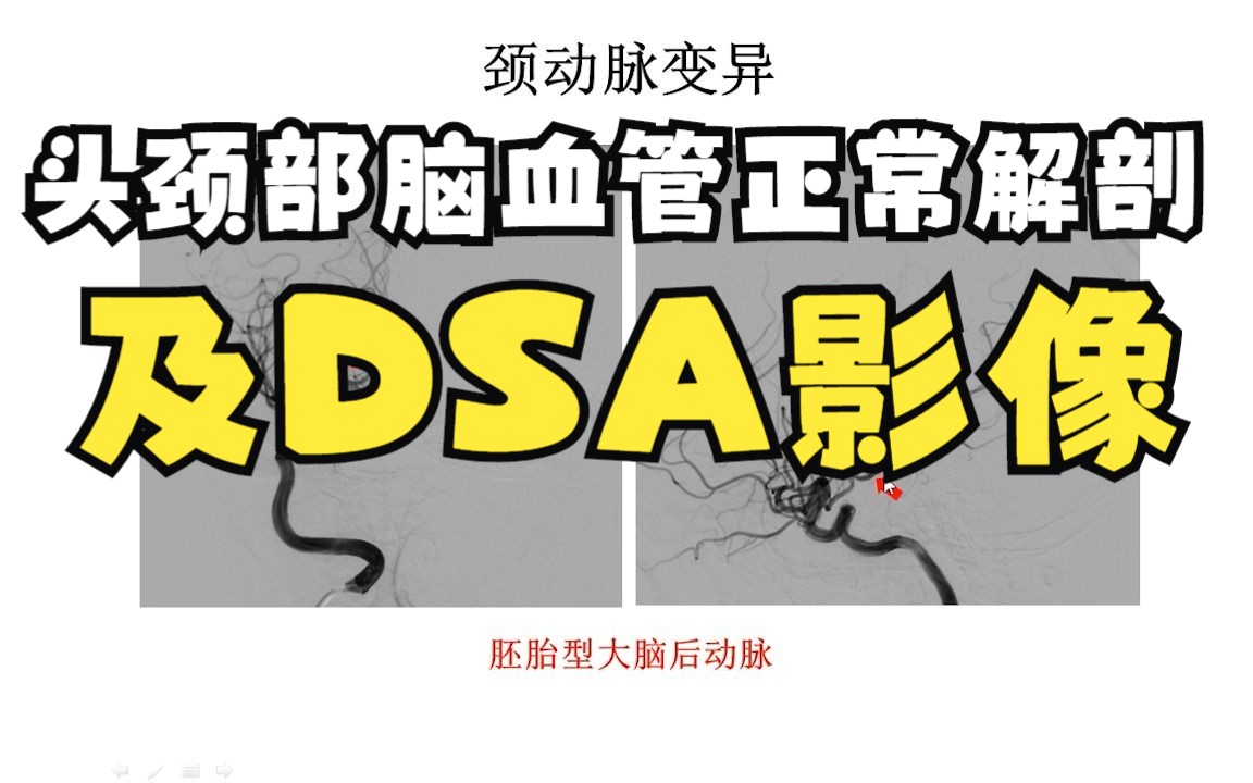 头颈部脑血管正常解剖及DSA影像