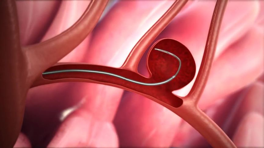 2分钟带你欣赏颅内动脉瘤栓塞术(高清动画)