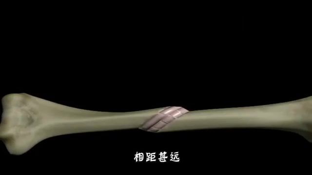 3D动画演示骨折之后不进行处理的结果