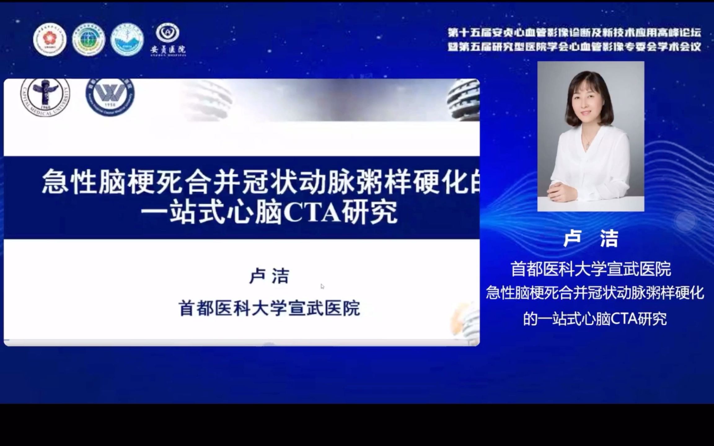 急性脑梗死合并冠状动脉粥样硬化的一站式心脑CTA研究——卢洁 ...