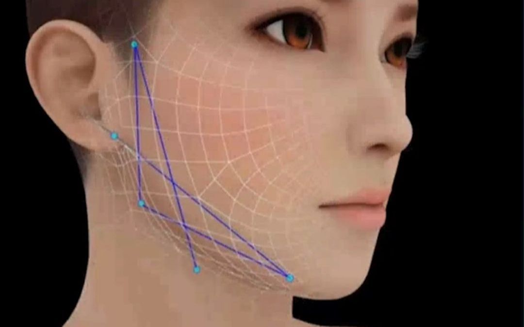 3D演示线雕提升下颌缘过程