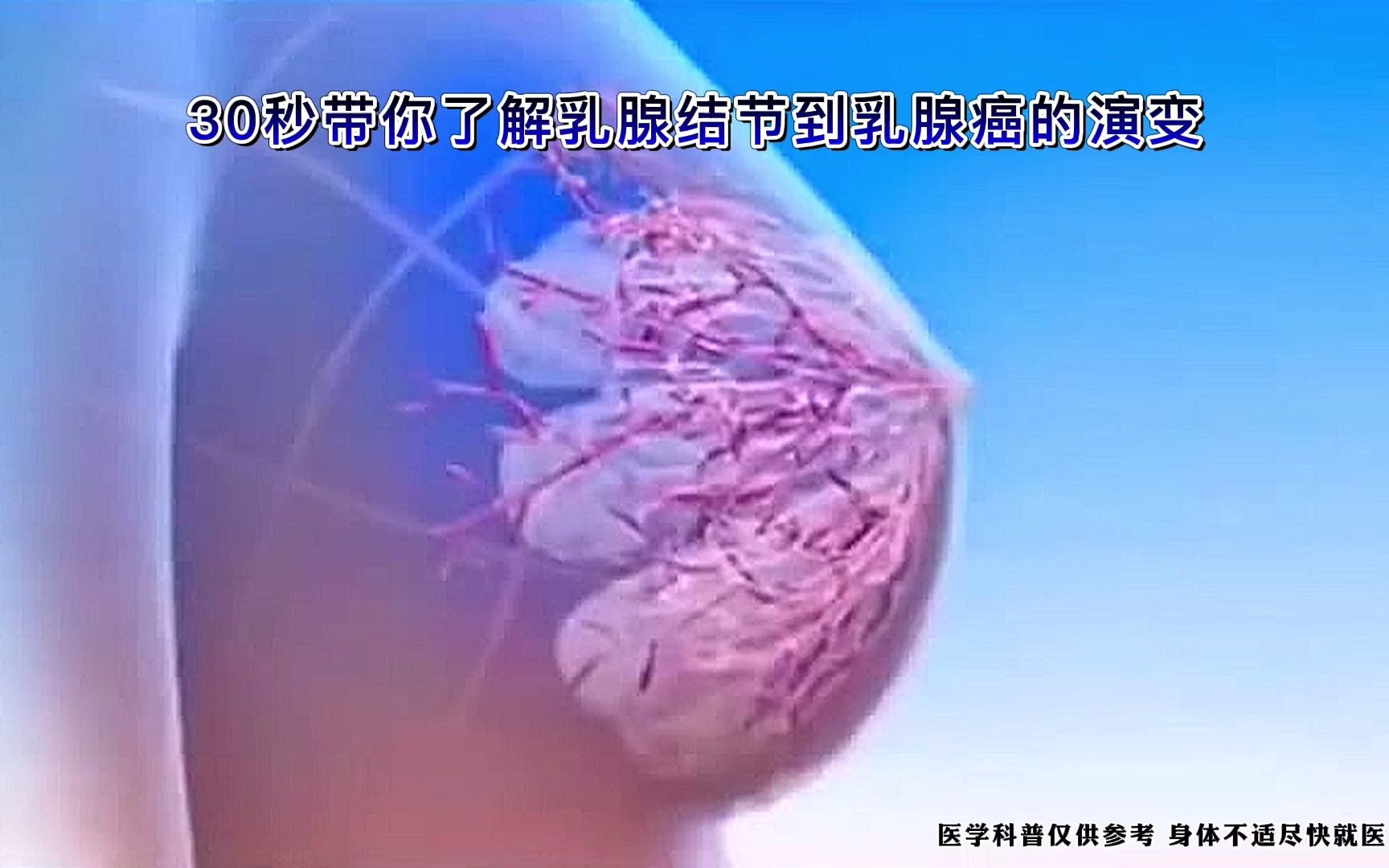 三十秒带你了解乳腺结节到乳腺癌的演变