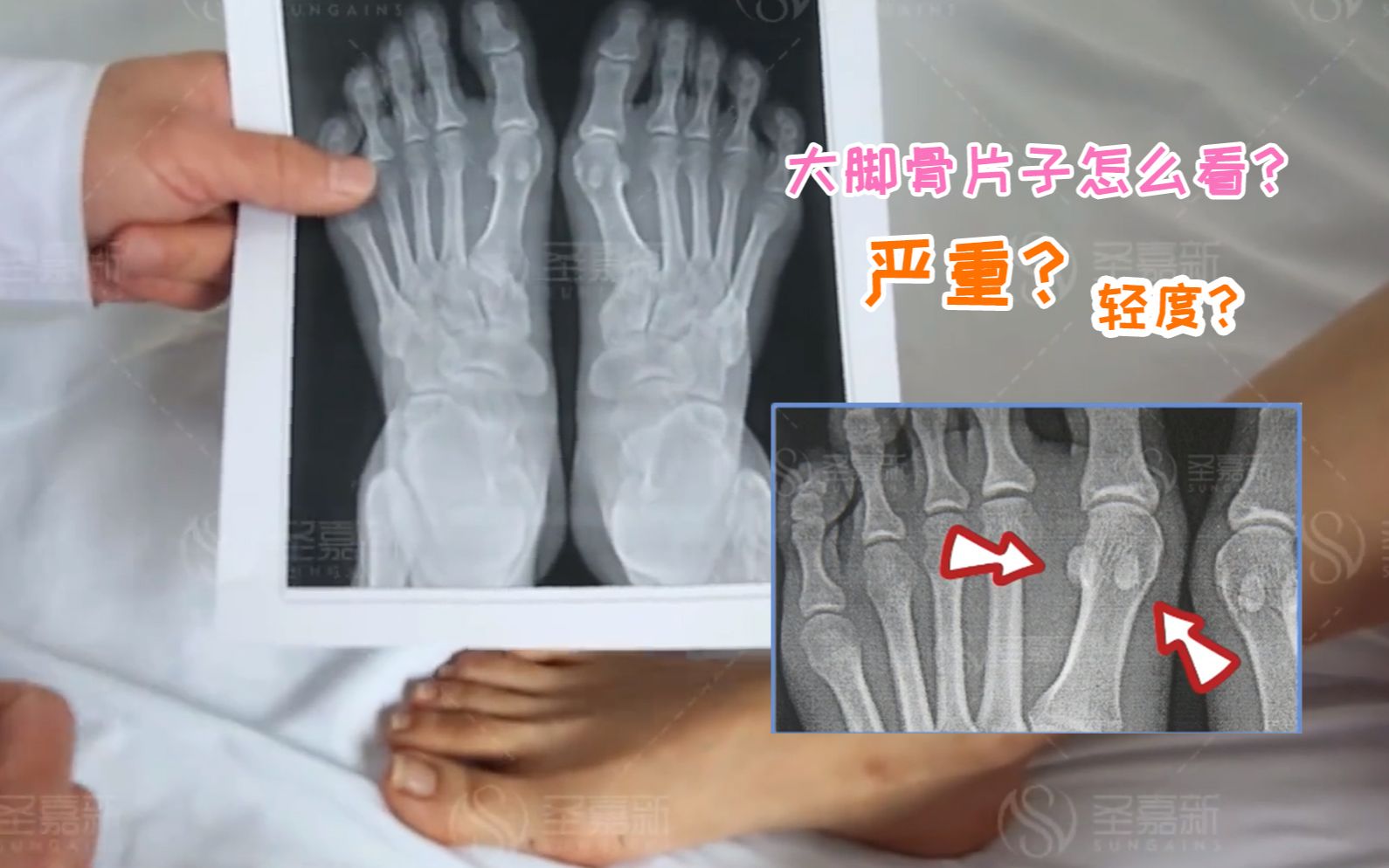 苏敬达说大脚骨系列|教你大脚骨X光片子怎么看,快速辨别大脚骨程度