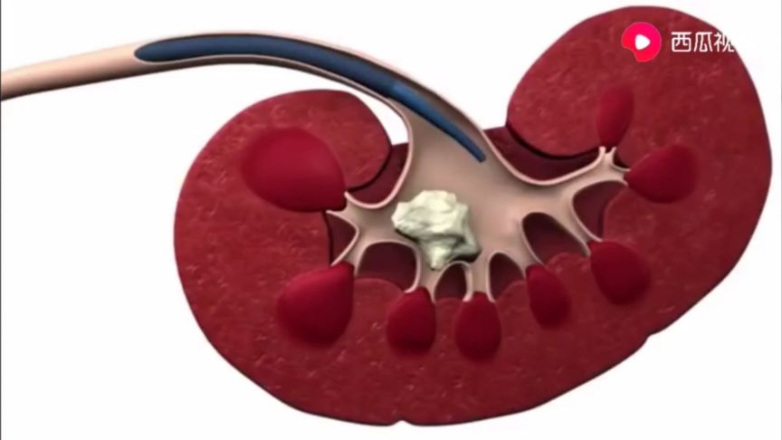 3D模拟肾结石手术过程