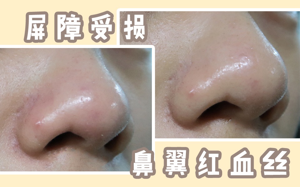 【方七七】干货向 | 皮肤屏障受损&鼻翼红血丝 困扰多年终于解决啦!