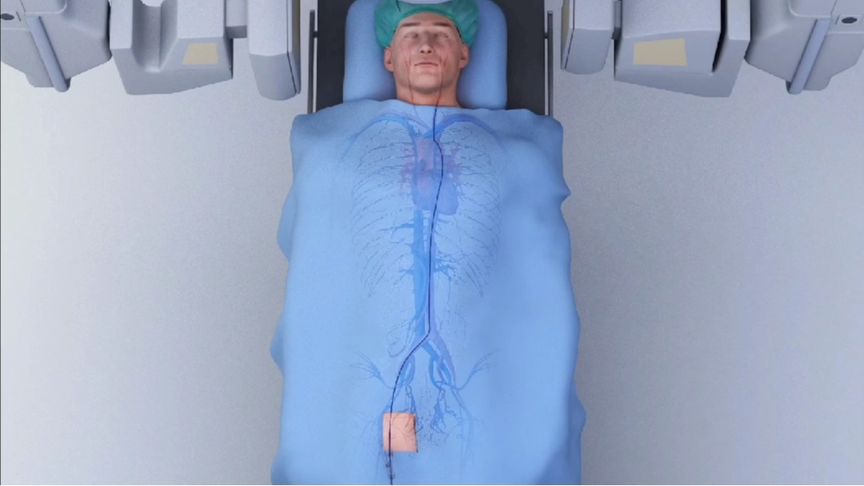 脑梗塞怎么取出血栓,3D演示。