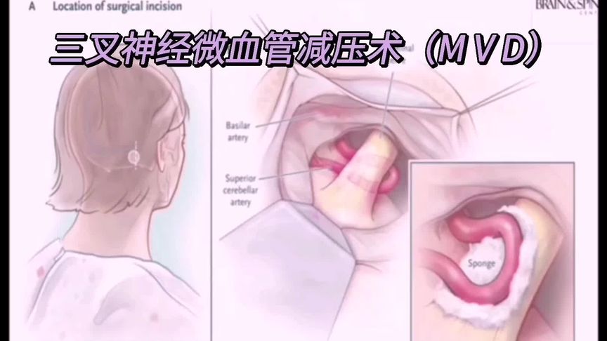 三叉神经微血管减压术(MVD)