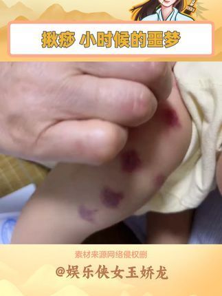 被揪痧支配的恐惧 #中暑 #夏天 #童年 #搞笑 #内容启发搜索