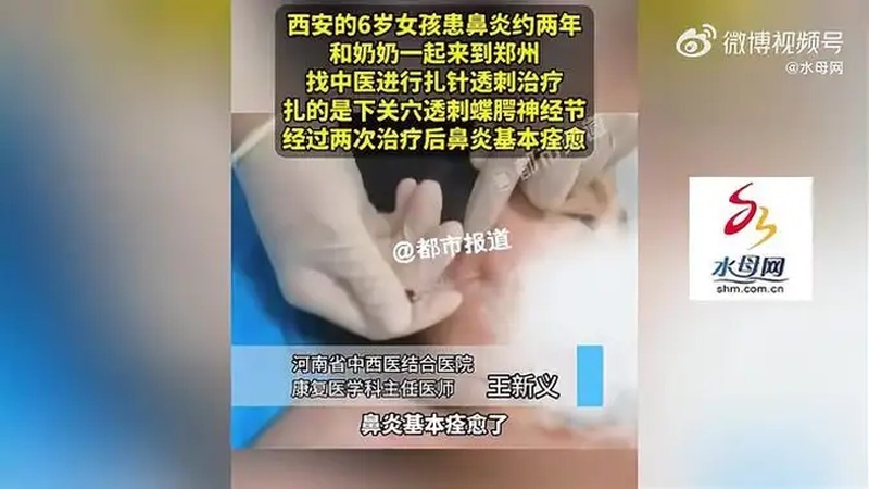 ...透刺治疗,扎的是下关穴透刺蝶腭神经节,经过两次治疗后鼻炎基本痊愈