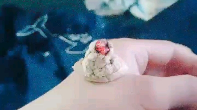 艾绒干姜,灸合谷。脸部爱出油的。可以试试。