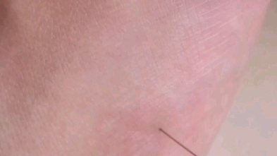 自己扎血海穴 ,出现吸针?拔出时肌肉跳动