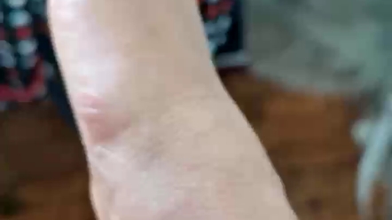 桡骨远端骨折怎么治疗?