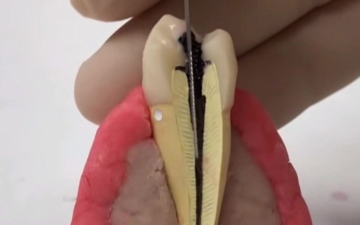 根管治疗从去腐到充填全过程