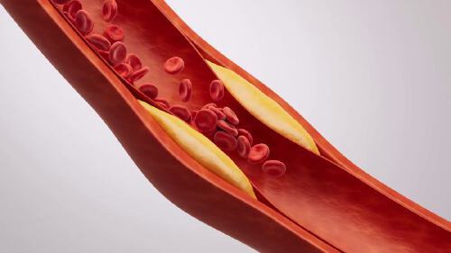 别再乱试药了!下肢动脉闭塞真正有效的治疗方案大揭秘