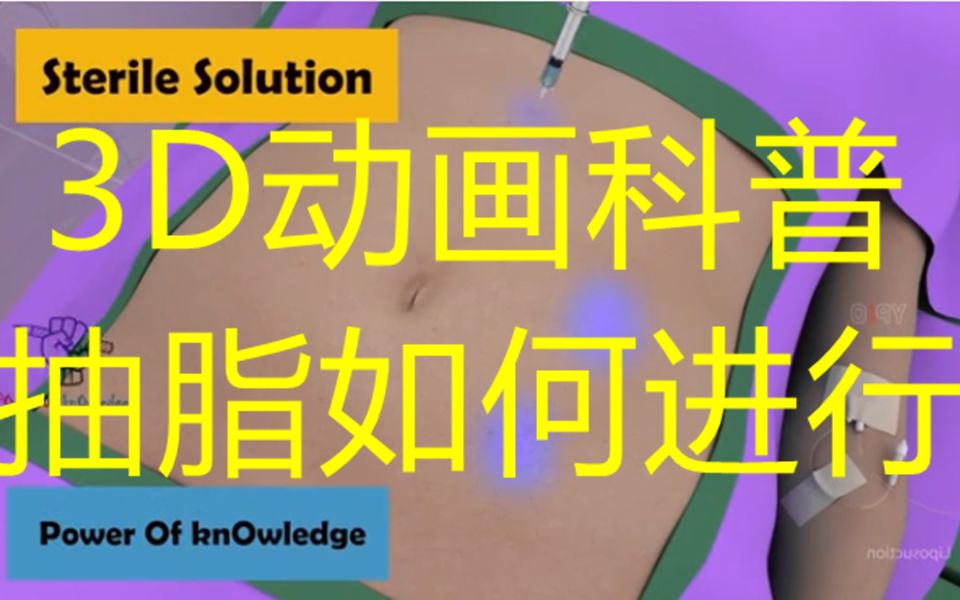 吸脂是如何进行的-3D动画科普
