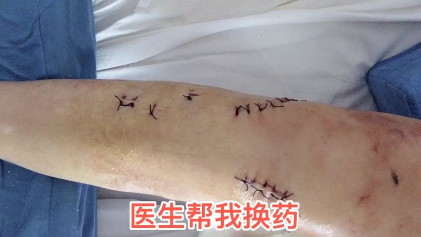 骨折手术后第5天,医生帮我换药,第1次看见伤口,很小美观