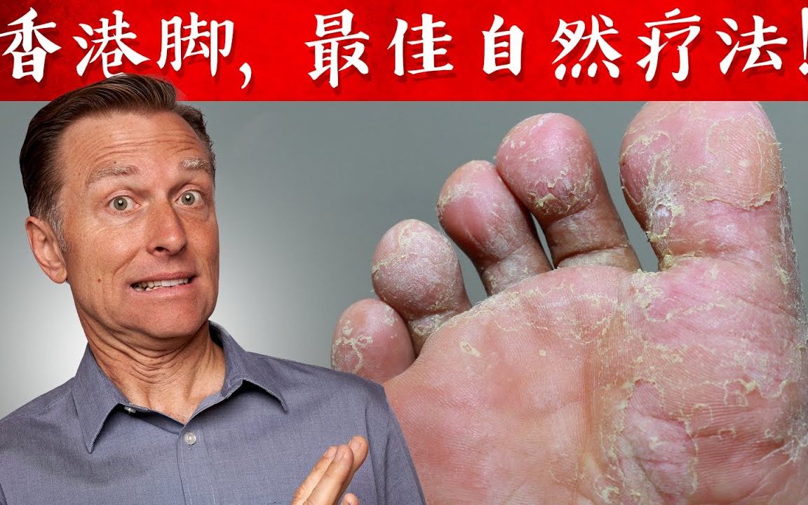 【简体中文字幕人工翻译】香港脚, 最佳自然疗法!自然疗法,柏格医生dr ...