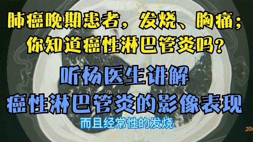 晚期肺癌患者,发烧,胸痛,你知道癌性淋巴管炎吗?听杨医生讲解