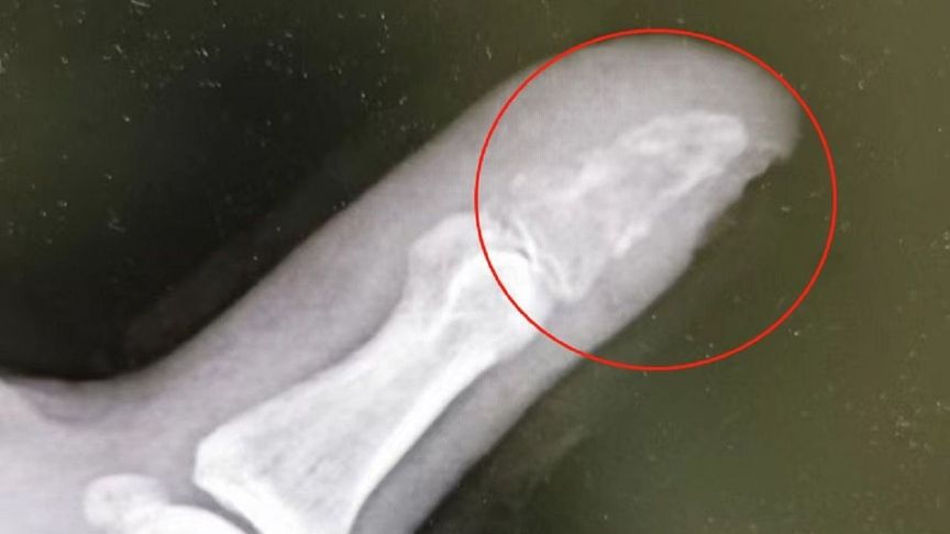 男子拇指被小狗咬伤,一个月后指骨被“吃空”