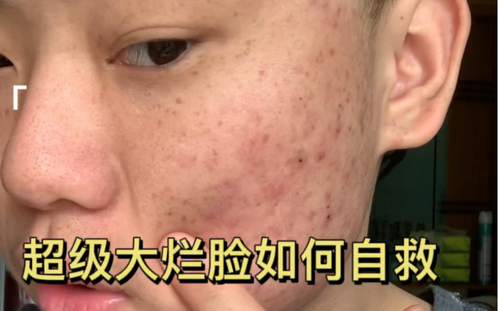 吃异维a酸真的可以祛痘吗?