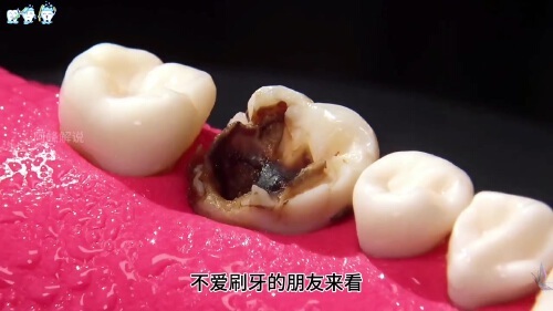 你知道根管治疗修复牙齿到底有多酸爽吗?