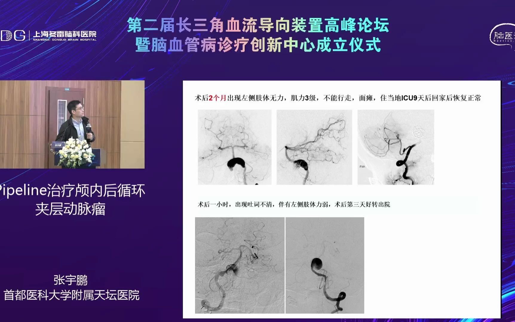 冬雷脑科第二届长三角血流导向装置高峰论坛-张宇鹏医生(首都医科...