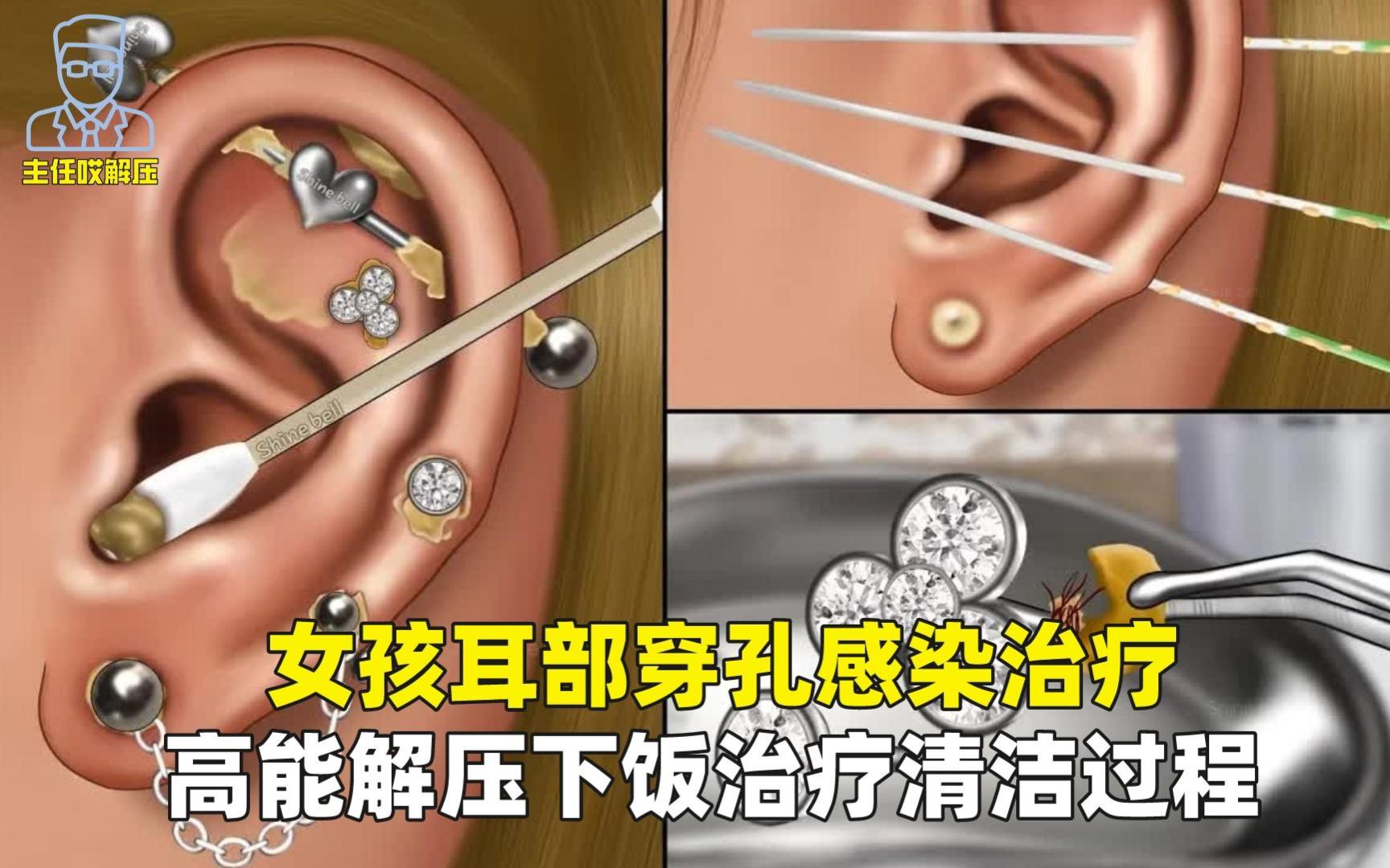 解压动画,耳朵穿孔感染清理治疗,强迫症的福音