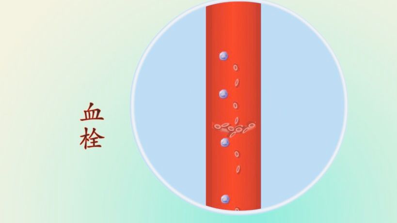 脑血栓是什么?和脑梗塞有关吗?发现脑血栓该如何处理?