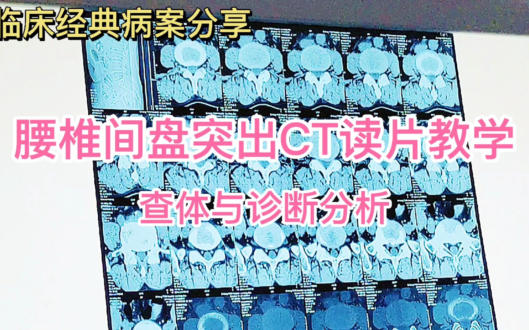 临床经典病案分享,腰椎间盘突出CT读片教学,查体与诊断分析