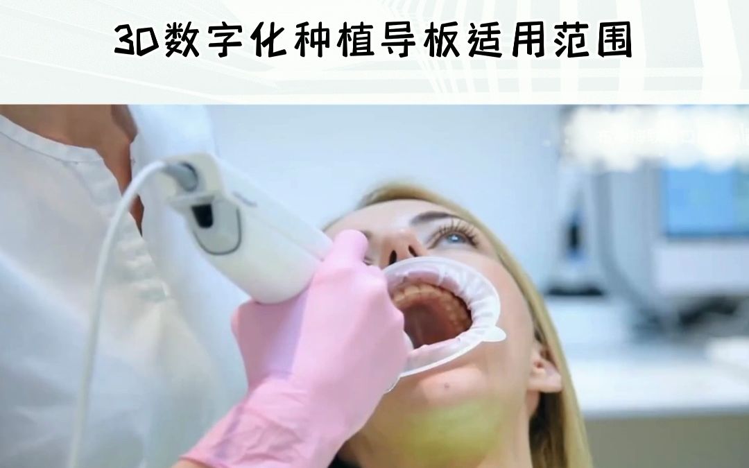 3D数字化种植导板适用范围