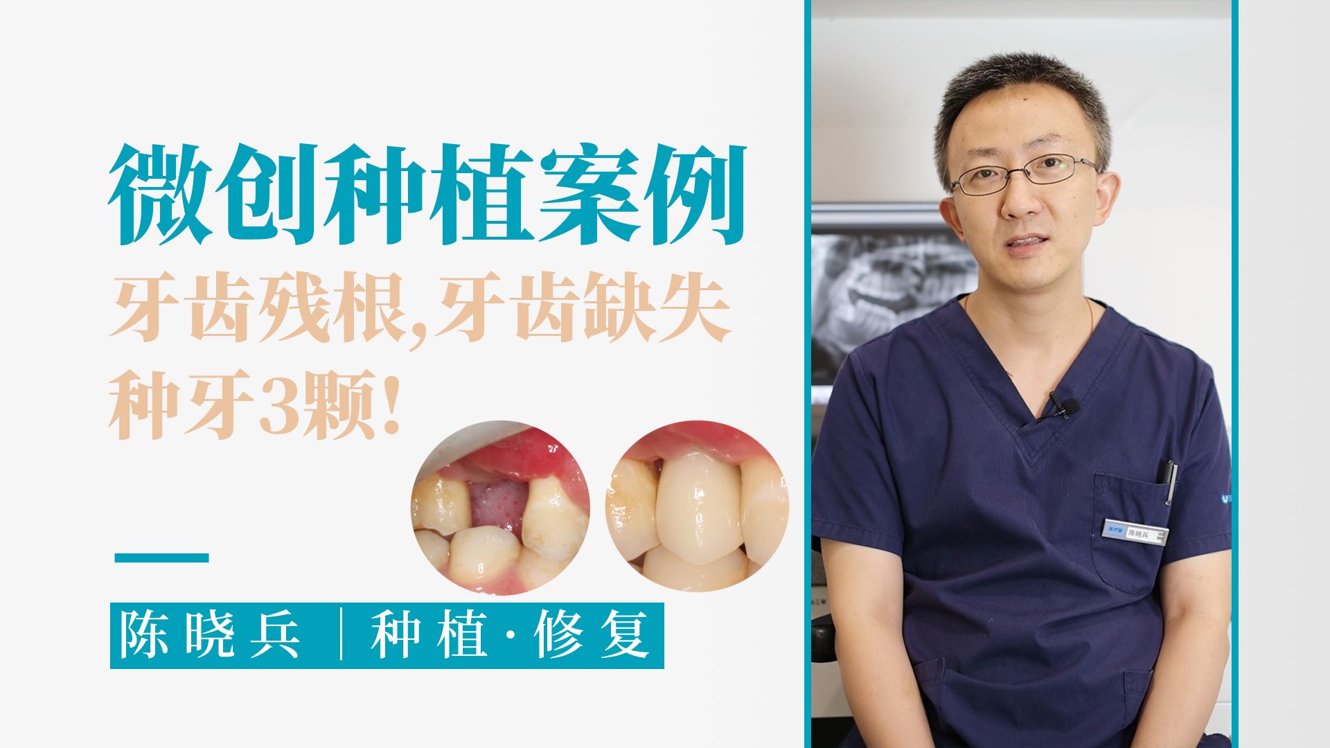 微创种植牙案例讲解|两颗残根,一颗缺失,种牙三颗