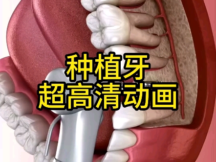 种植牙超高清动画,一看就懂!
