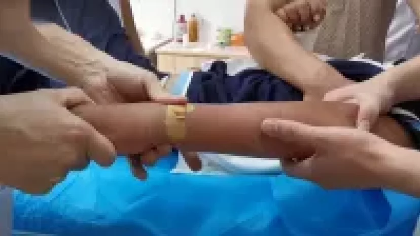 赣南正骨 手法复位 - 桡骨远端双骨折