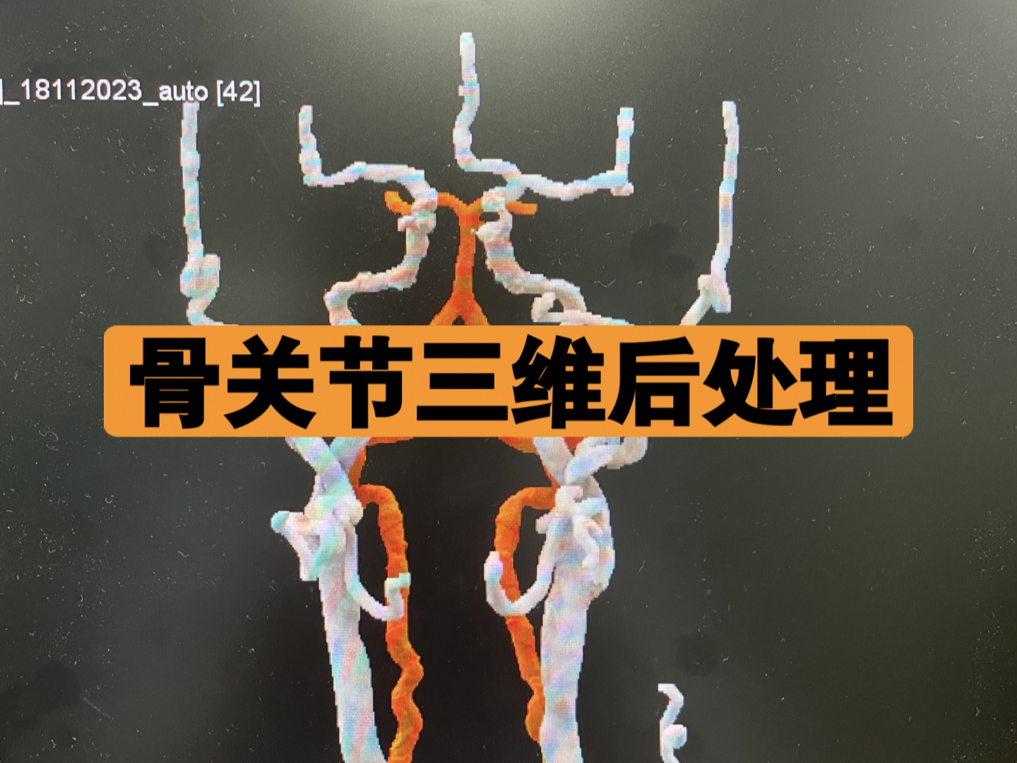 骨关节三维后处理!操作流程!