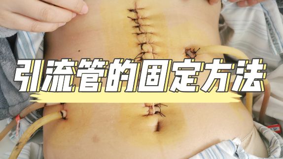 引流管的固定方法(三)#医疗#引流管#护理