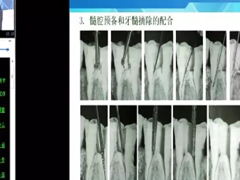 18根管预备的护理配合