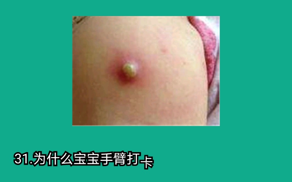 31.为什么宝宝手臂打卡介苗处化脓了也没事?