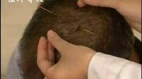 32-四神聪(通络开窍.宁神益脑、主治头痛.眩晕.失眠、健忘、痴呆.)——...