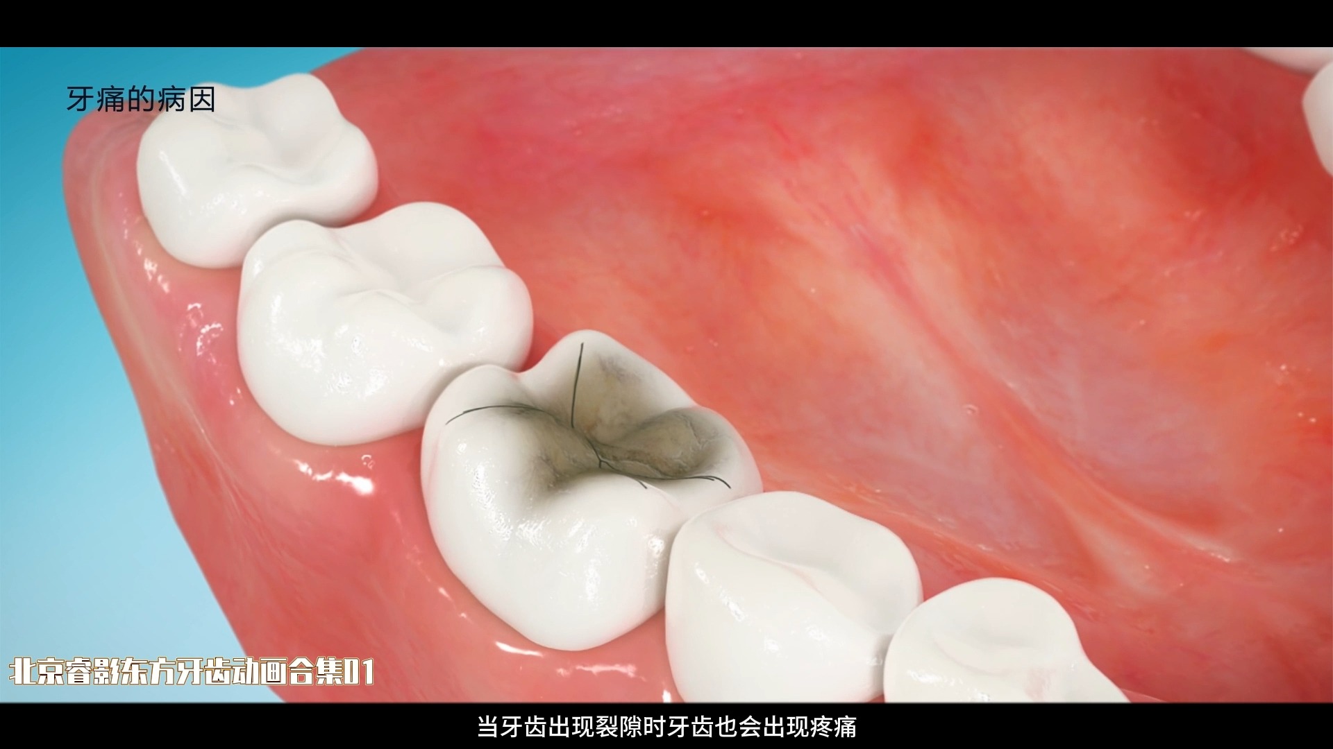 【3D医学动画】口腔牙齿系列动画之牙痛的病因