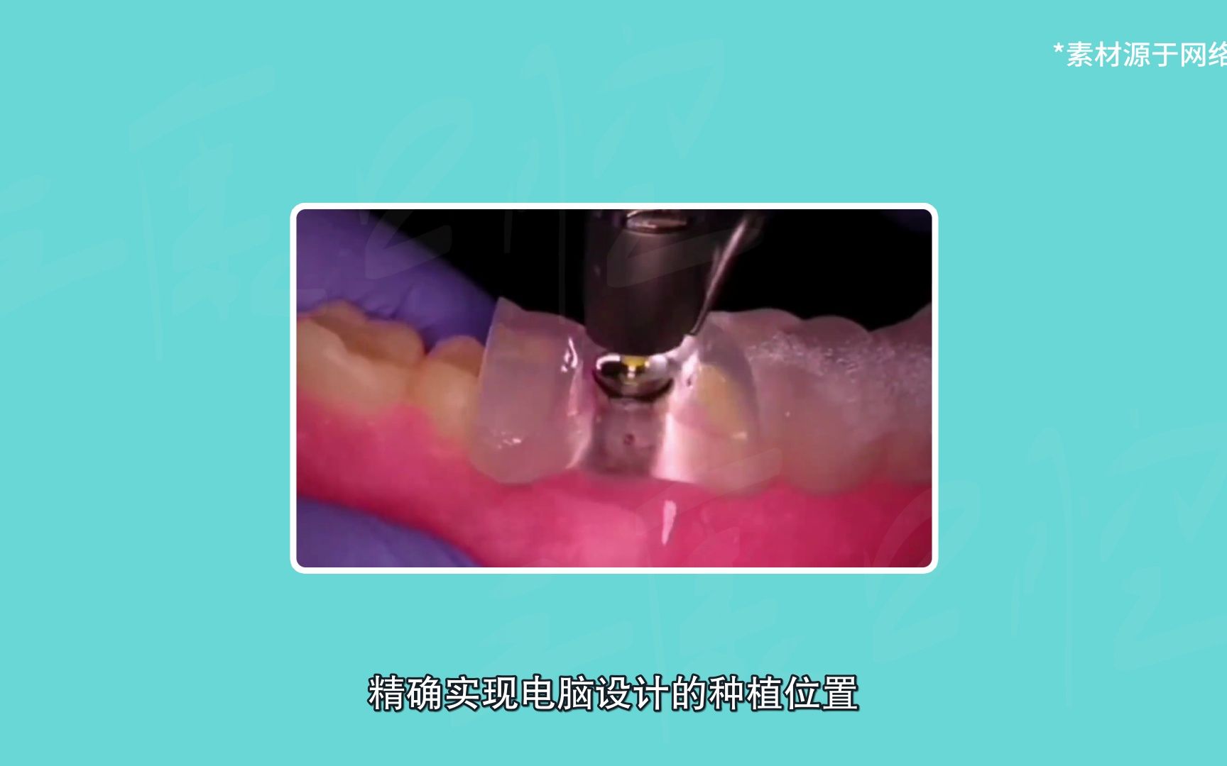 【深圳种植牙科普】想植牙但怕疼,微创种植牙手术真的不疼吗?