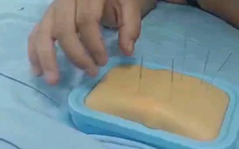 针灸技术之捻针手法