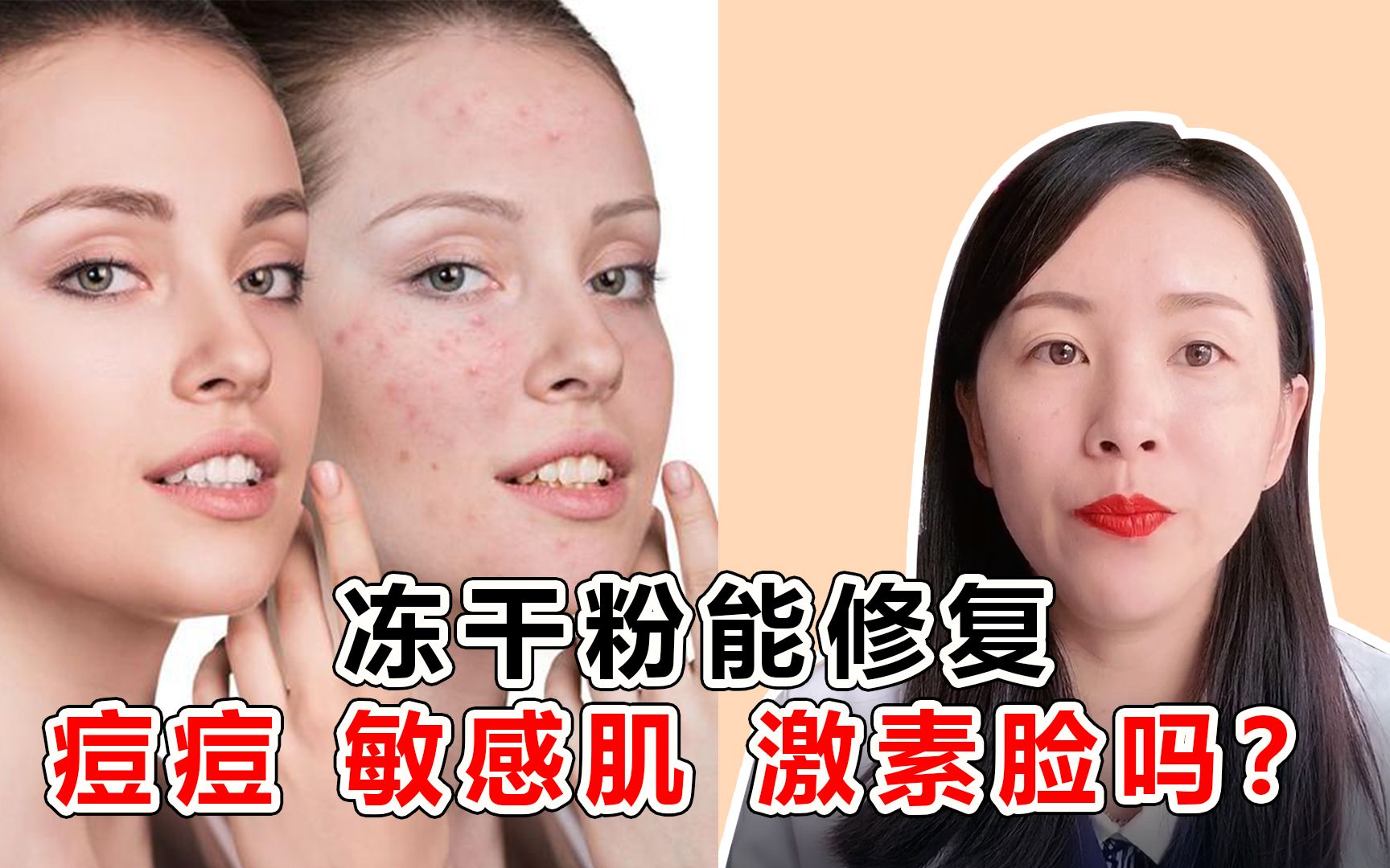 脸上长痘怎么办?冻干粉的作用,了解去痘小知识,怎么样才能去除痘痘